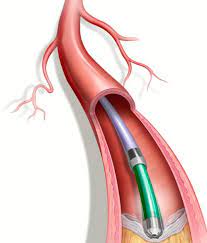 Flowcardia - Gilde Healthcare