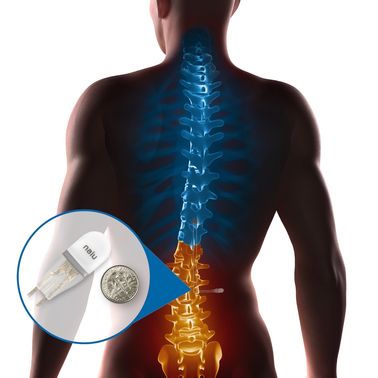 Nalu Medical - Gilde Healthcare