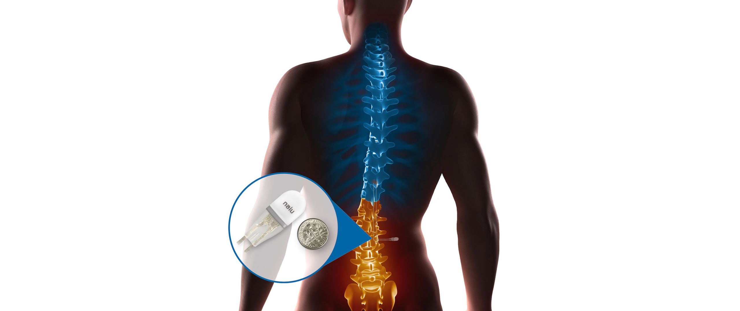 Nalu Medical - Gilde Healthcare